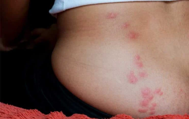 √ Was tun Bettwanzen stiche Sehen aus wie? Wie man die Symptome erkennt