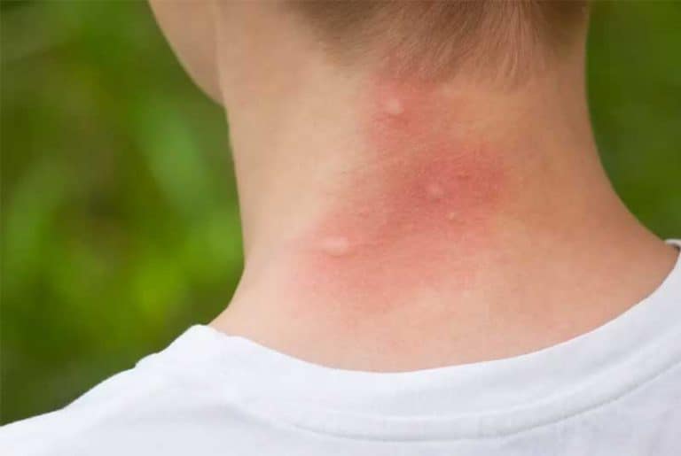 Verwunderlich Bettwanzen Stich Behandeln Bilder